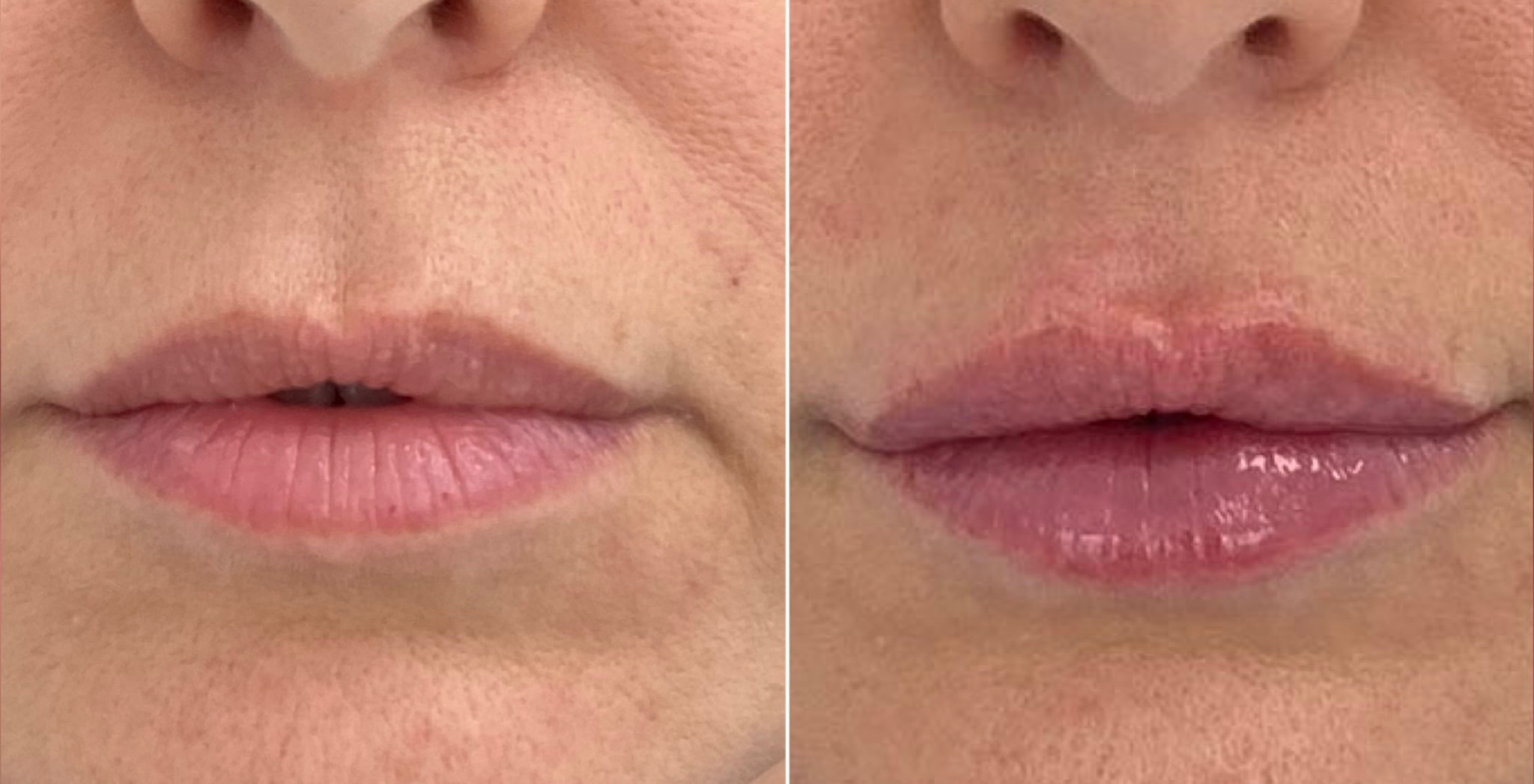 Filler aumento volume Labbra Padova | Risultati naturali - AES CLINC
